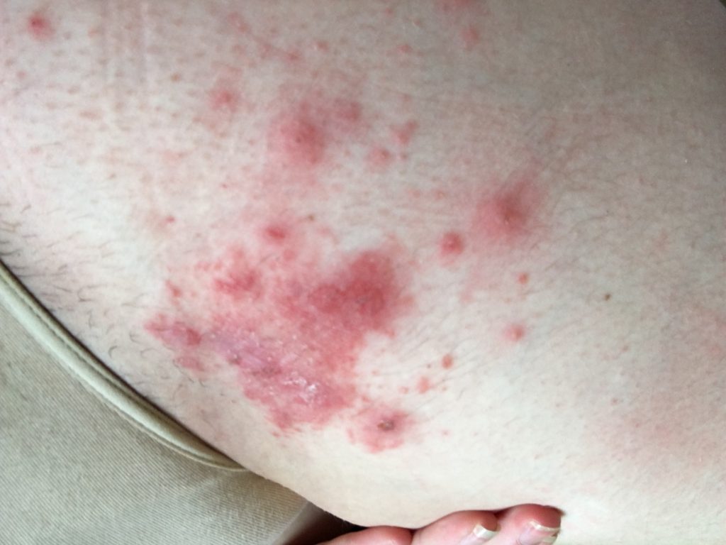 I have a rash on my upper inner thigh, could be STI, and spreading ...